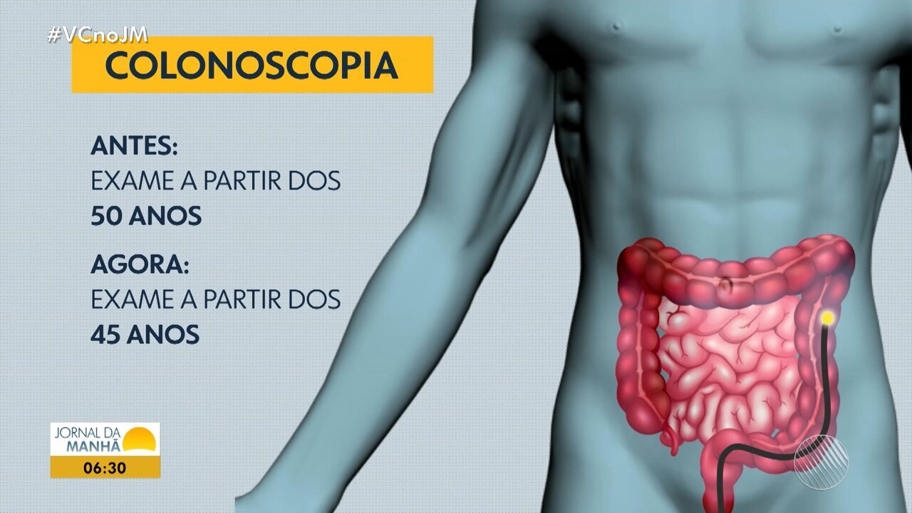 Jornal Da Manhã Saúde Diagnóstico Precoce Do Câncer De Intestino